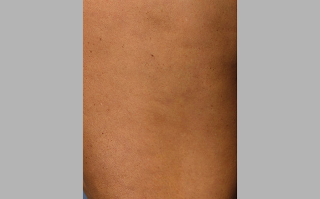 Cellulite Treatment Palm Harbor - Better Life Clinics