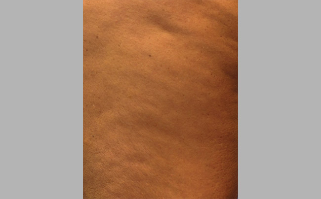 Cellulite Treatment Palm Harbor - Better Life Clinics