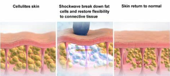 Shockwave Therapy for Fast Relief - Better Life Clinics