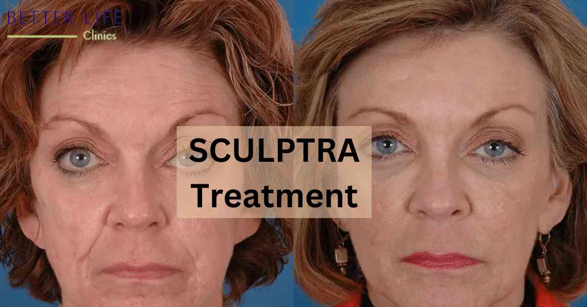 Facial Rejuvenation with Sculptra | Better Life Clinics