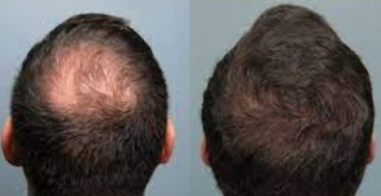 Understanding Androgenetic Alopecia: Causes, Treatment Options & Prevention Strategies - Better ...